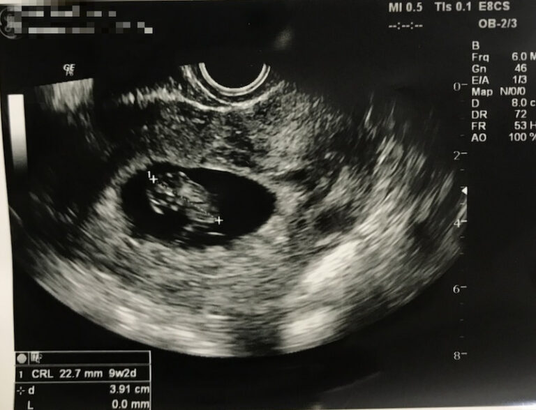 妊娠経過 8w5d クリニック受診 ※エコー画像あり | ちゃーはん丸と妻の後腹膜腫瘍闘病記と不妊治療